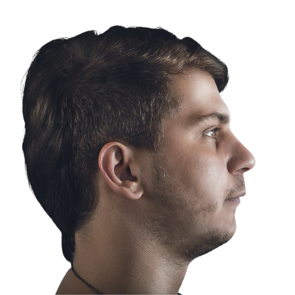 class II skeletal : receding chin