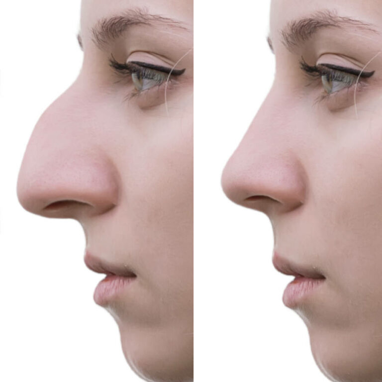 Rhinoplasty, nose surgery simulation - Surgical simulator before/after
