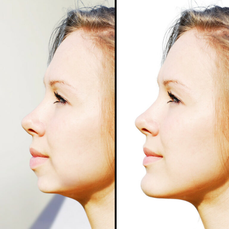 Chin lengthening - Genioplasty - Simulation - Surgical before-and-after ...