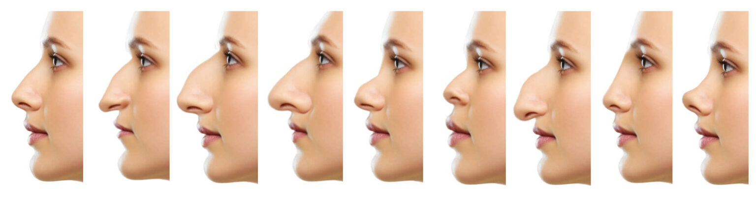 9 nose shapes : rhinoplasty - Surgical before-and-after simulator