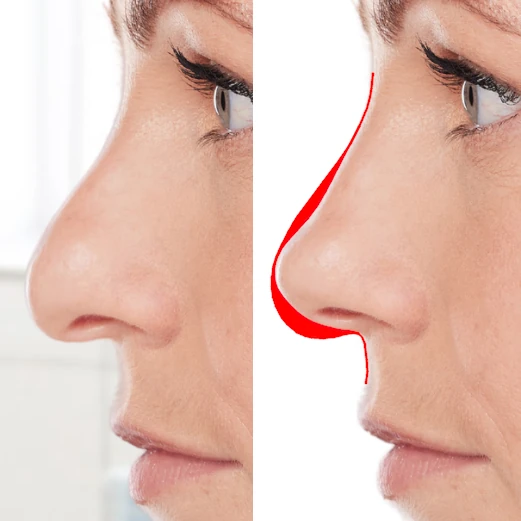 Crow's nose after a failed rhinoplasty