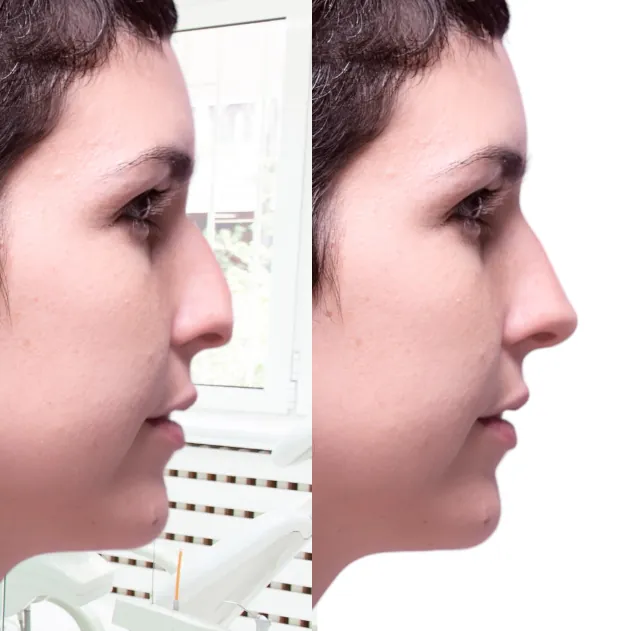 Non-surgical rhinoplasty : hyaluronic acid injections