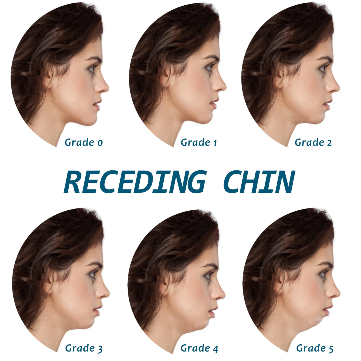 Receding chin and class II malocclusion - Surgical simulator before/after