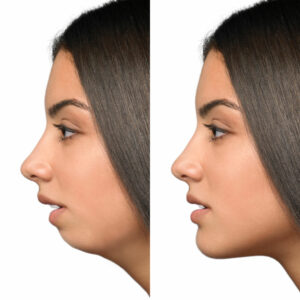 Surgical before-and-after simulator - Flat chin, receding chin, chin back