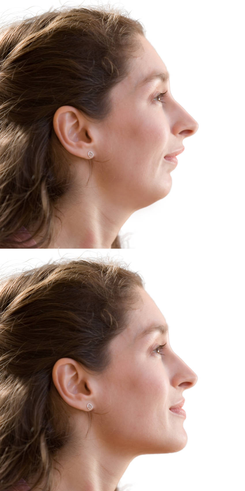Chin advancement simulation - Surgical before-and-after simulator