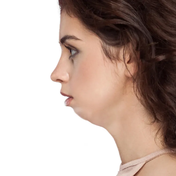 Receding chin - Surgical simulator before/after