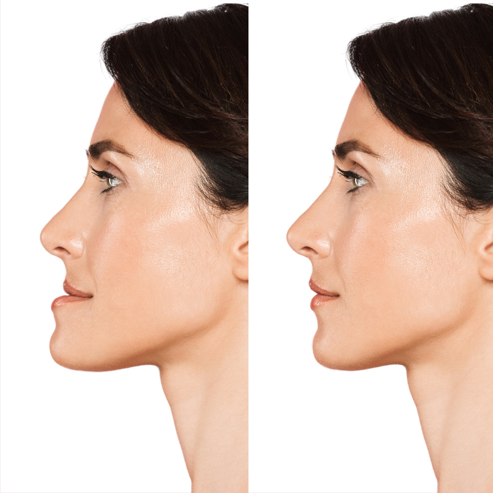 Protruding chin - Surgical simulator before/after