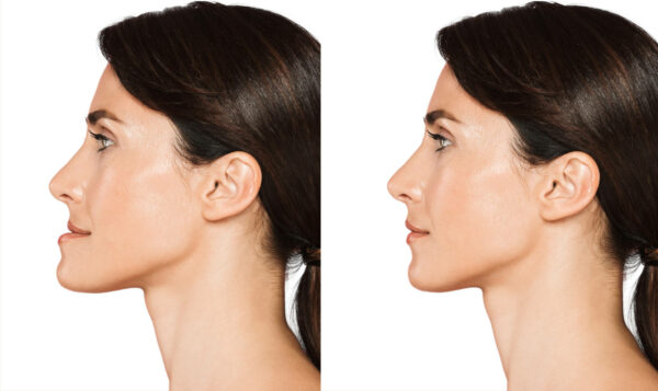 Protruding chin - Surgical simulator before/after