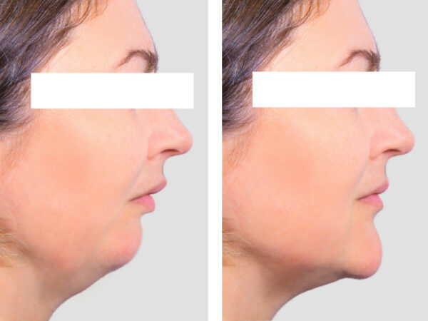 Recessed chin (or receding jaw) - Surgical simulator before/after
