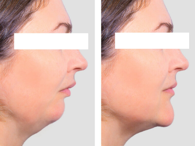 Recessed chin (or receding jaw) - Surgical simulator before/after