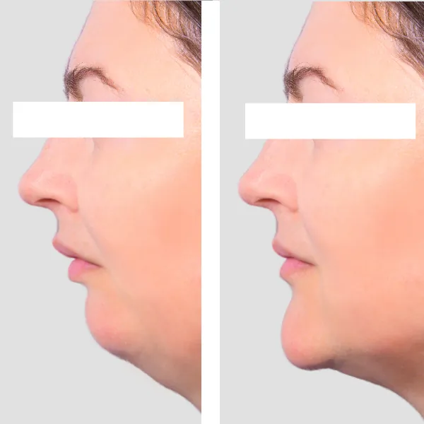 Recessed chin (or receding jaw) - Surgical simulator before/after