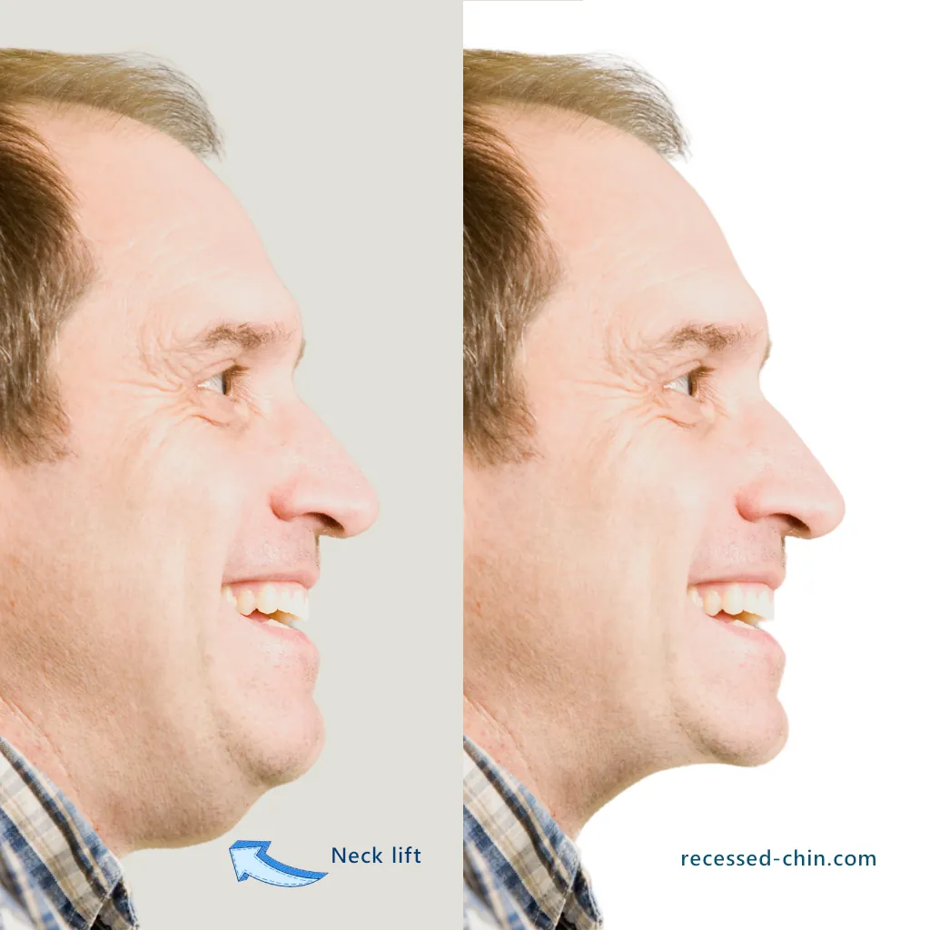 How a neck lift is performed - Surgical simulator before/after