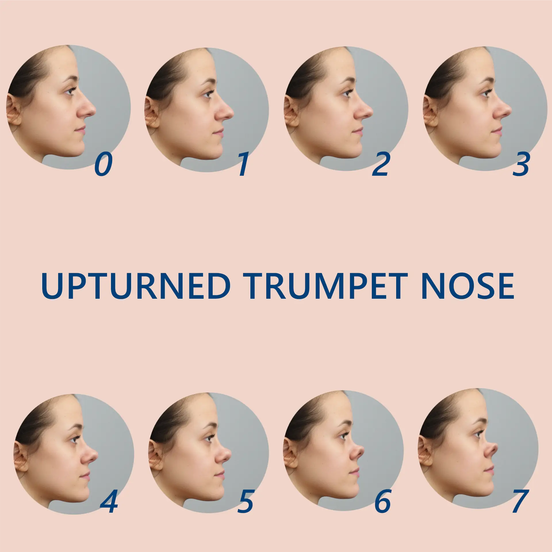 Upturned nose on trumpet : 7 styles - Surgical simulator before/after