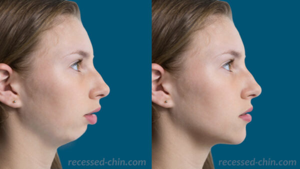 Receding chin photo - Surgical simulator before/after